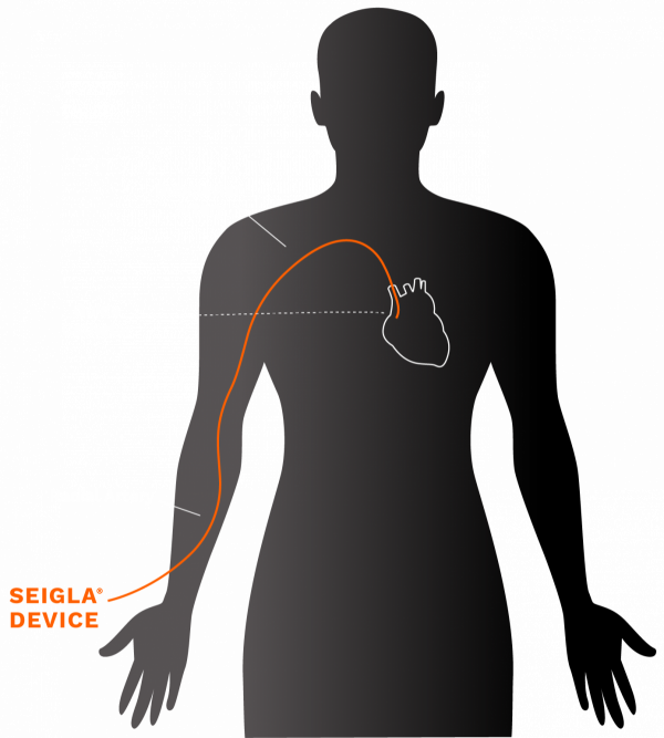 Radial Access - Seigla Medical